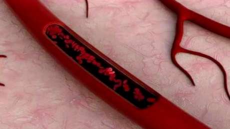 科普血栓诱发的三种疾病,但是它也有“克星”,每天吃点通血管!