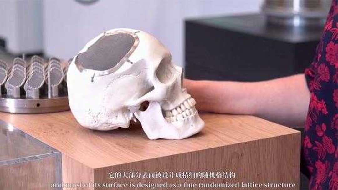金属3D打印在医疗技术中的应用-从单个植入物到批量生产