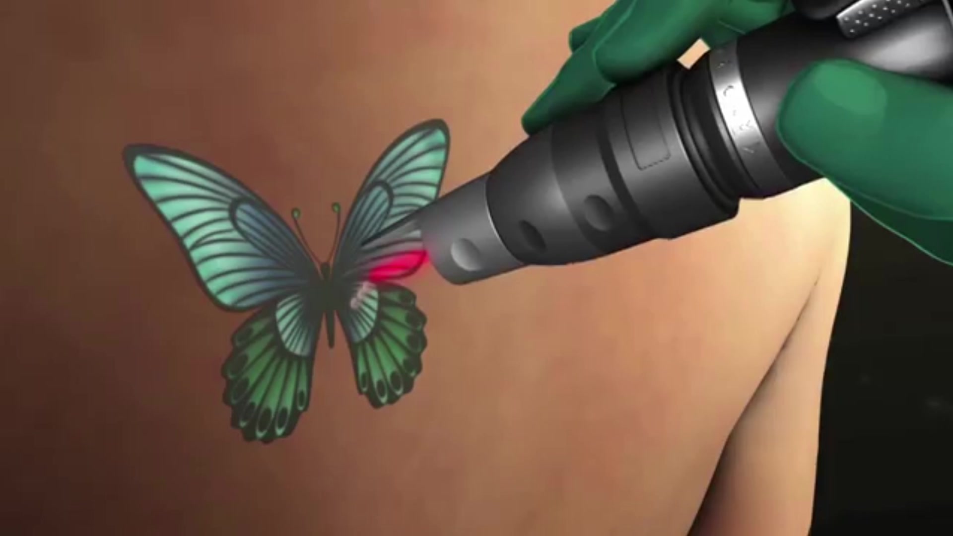 激光黑科技,嫌纹身丑?瞬间粉碎纹身!无疤 无焦味