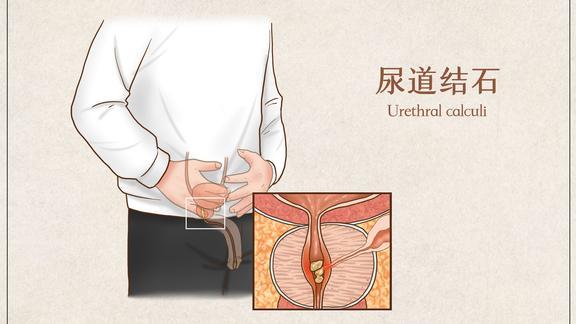 结石最爱年轻人,结石堵住了输尿管?是什么原因导致的尿路结石
