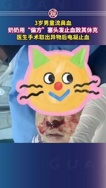 ...奶奶用“偏方”塞头发止血致其休克,医生手术取出异物后电凝止血