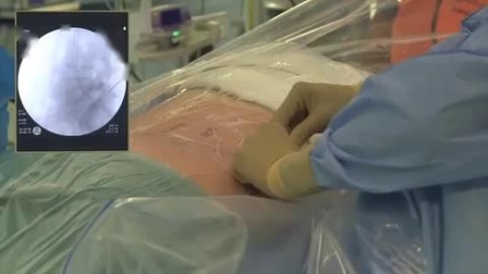 Dr. Harhangi 椎间孔镜手术全流程