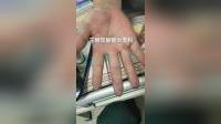 四肢型脉管炎手部症状改善