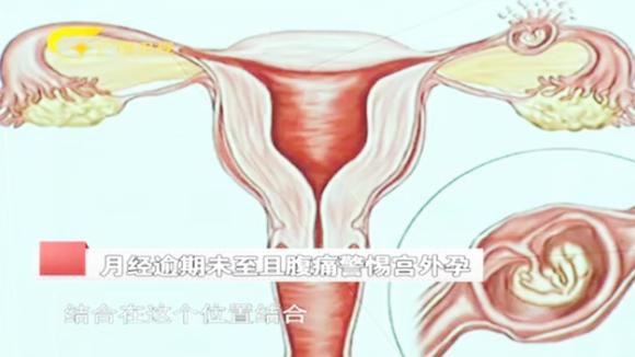 女性朋友要注意!月经逾期未至且有腹痛,需警惕宫外孕