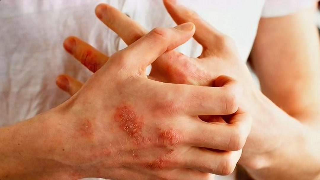 湿疹用什么药膏最有效?医生专业建议,一步到位!不走弯路