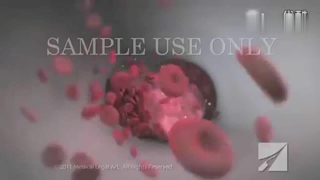 医学3D动画演示:下肢深静脉血栓形成(DVT)和肺栓塞(PE)