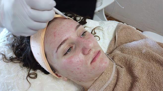 治疗痤疮,壬二酸和水杨酸祛痘使用顺序哪个更有效?