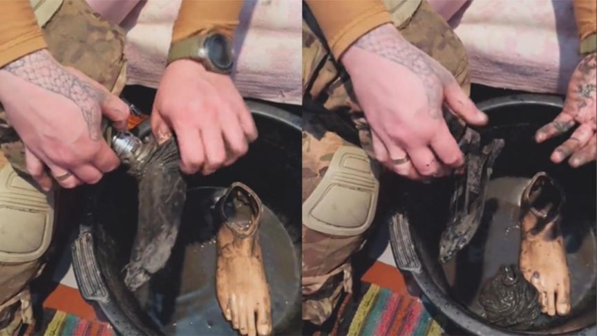 战争无情!乌军伤残军人失去右脚,靠着假肢继续生活