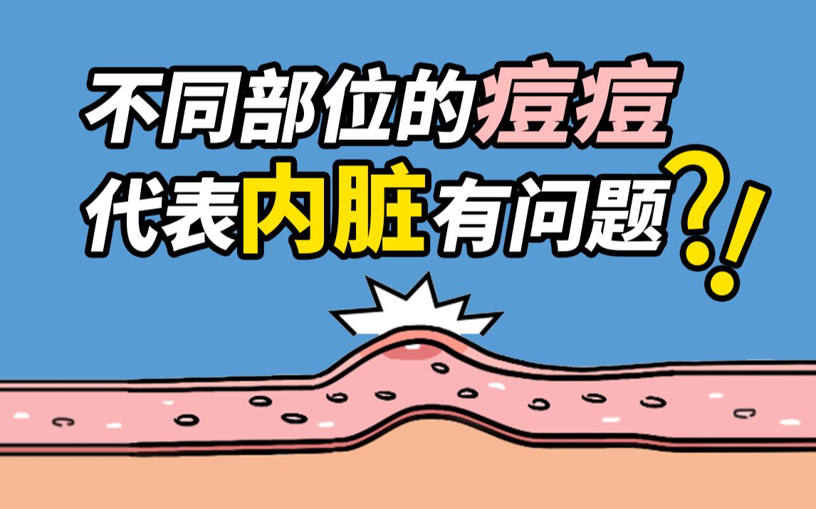 【痤疮科普100问】你的痘痘都长在哪里?