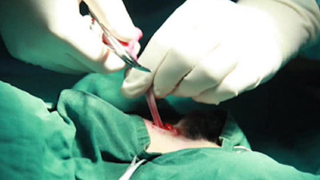 男性结扎手术对身体有危害?看完3D过程,心里不由的一紧!