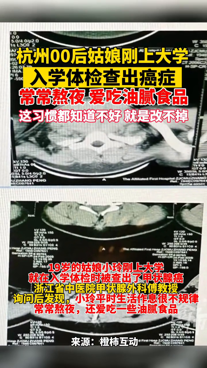 入学体检查出癌症,她常常熬夜,爱吃油腻食品……