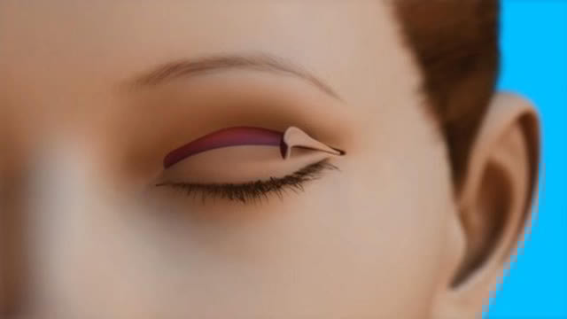 双眼皮手术的过程什么样?3D动画模拟,看完你还敢去吗?