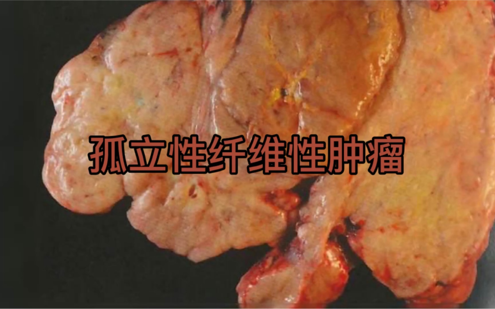 聊聊「孤立性纤维性肿瘤」:从之前被误认为是间皮瘤,到如今的分子学...