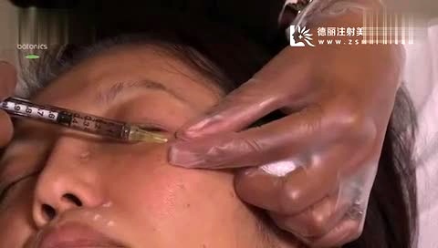 德丽微整形注射肉毒杆菌除皱放松