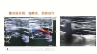 轻松掌握血管超声(颈部动脉)-黄珍砾