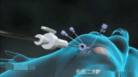 胆囊切除手术演示动画 包医二附院消化微创中心