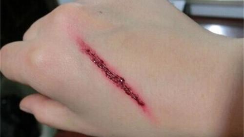 祖传土方专治伤口快速愈合, 一辈子不会留疤痕