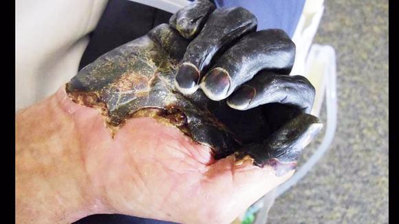 最恐怖的3大传染病,曾夺走数亿人生命,有的至今每年300万人感染