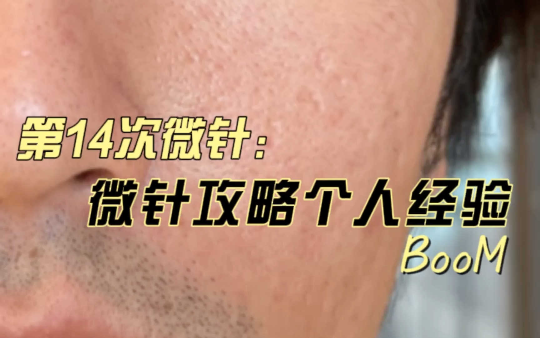 微针对皮肤有什么作用?微针真的能改善痘坑吗?微针适合什么皮肤去做...