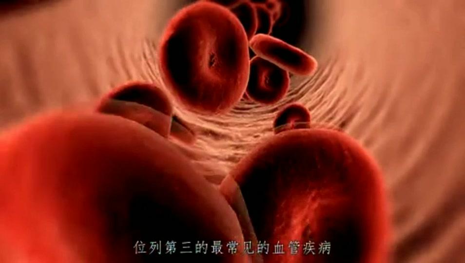 静脉血栓科普视频2,医院同事自己制作,我给予配音,获奖作品,有喜欢...