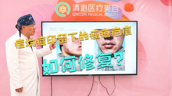痘坑痘印留下的痤疮疤痕应如何修复?