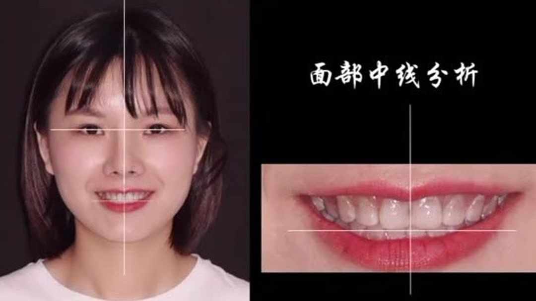 DSD微笑设计分析