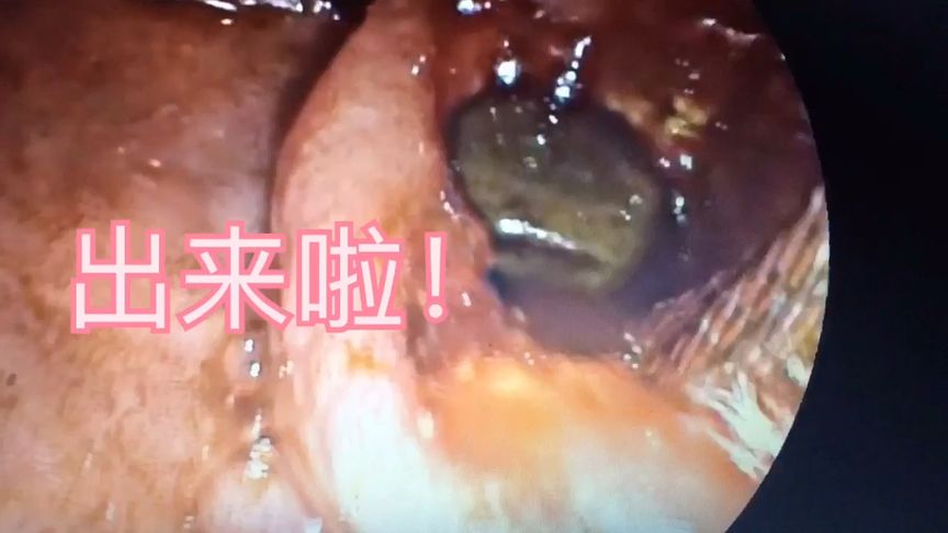 胆总管结石微创取石术