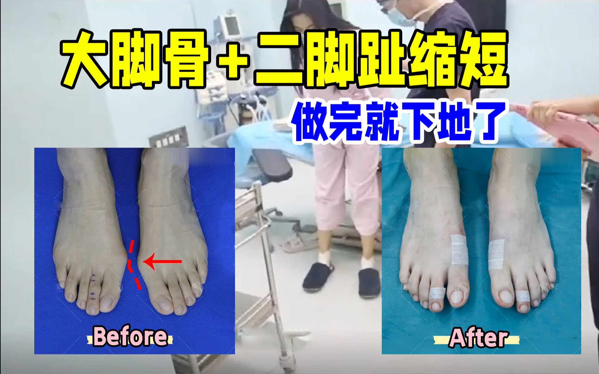 【苏敬达】拇指外翻+第二脚趾太长,手术一并解决,做完就下地了