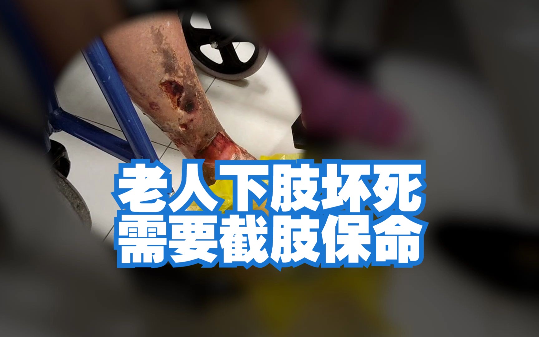 高龄患者患动脉硬化性闭塞症,导致下肢坏死溃烂,需要截肢以防进一步...