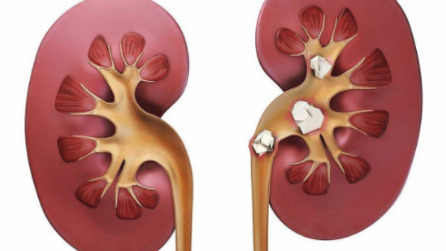 结石治疗需谨慎,输尿管软镜取肾结石到底好不好?