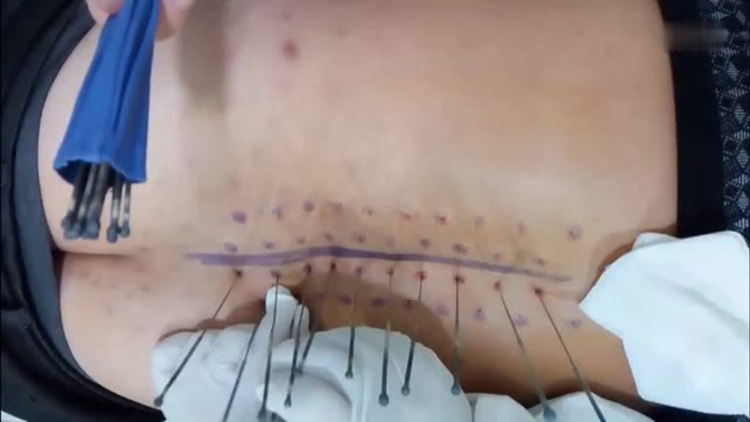 银质针针刺腰椎治疗腰痛