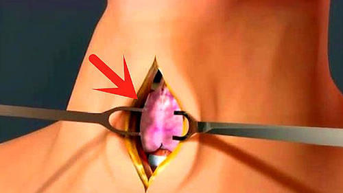 手术中插的气管是怎么插的?3D动画演示全程,网友:看着都疼!