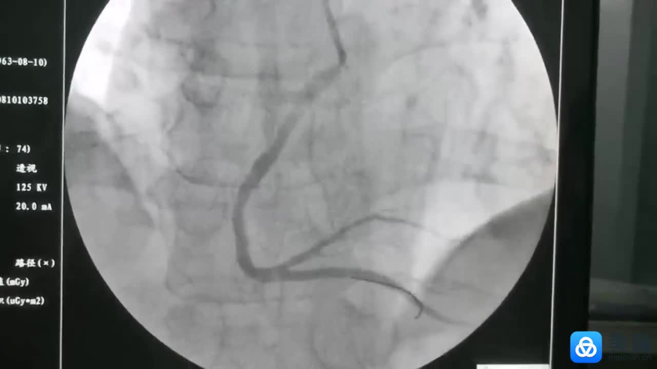 PCI后血管完全再通!