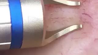 #美容仪器厂家 #美容院 #皮肤管理 #去红血丝