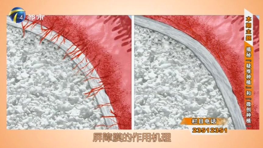 骨粉怎么使用?一组动画还原引导骨再生的过程|健康直播间