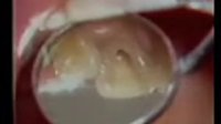 根管治疗术