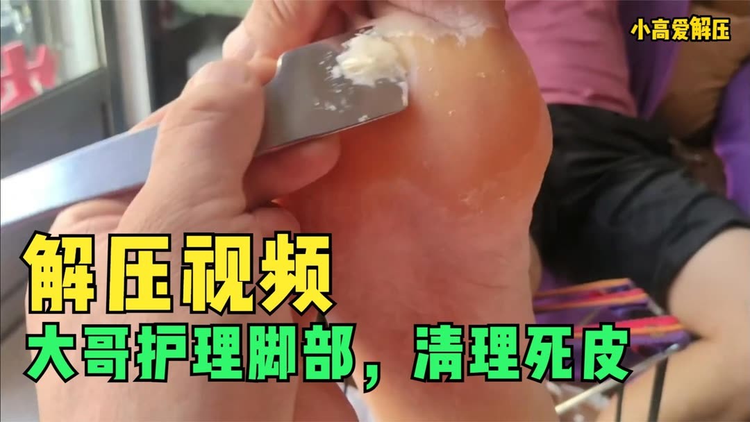 解压修脚,大哥脚上死皮太多了,赶紧用刮刀刮下来清理一番