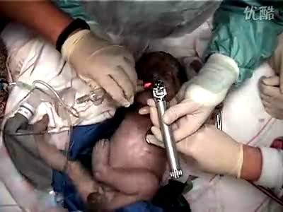 胎粪吸引管的使用