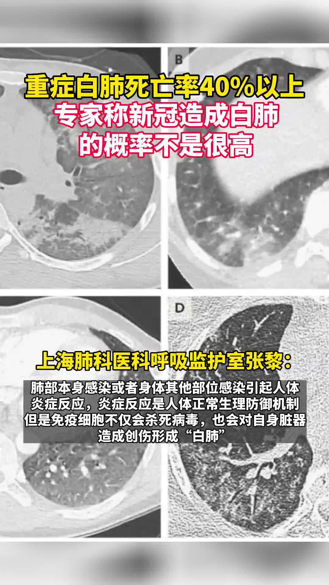 ...死亡率40%以上,专家称新冠造成白肺的概率不是很高