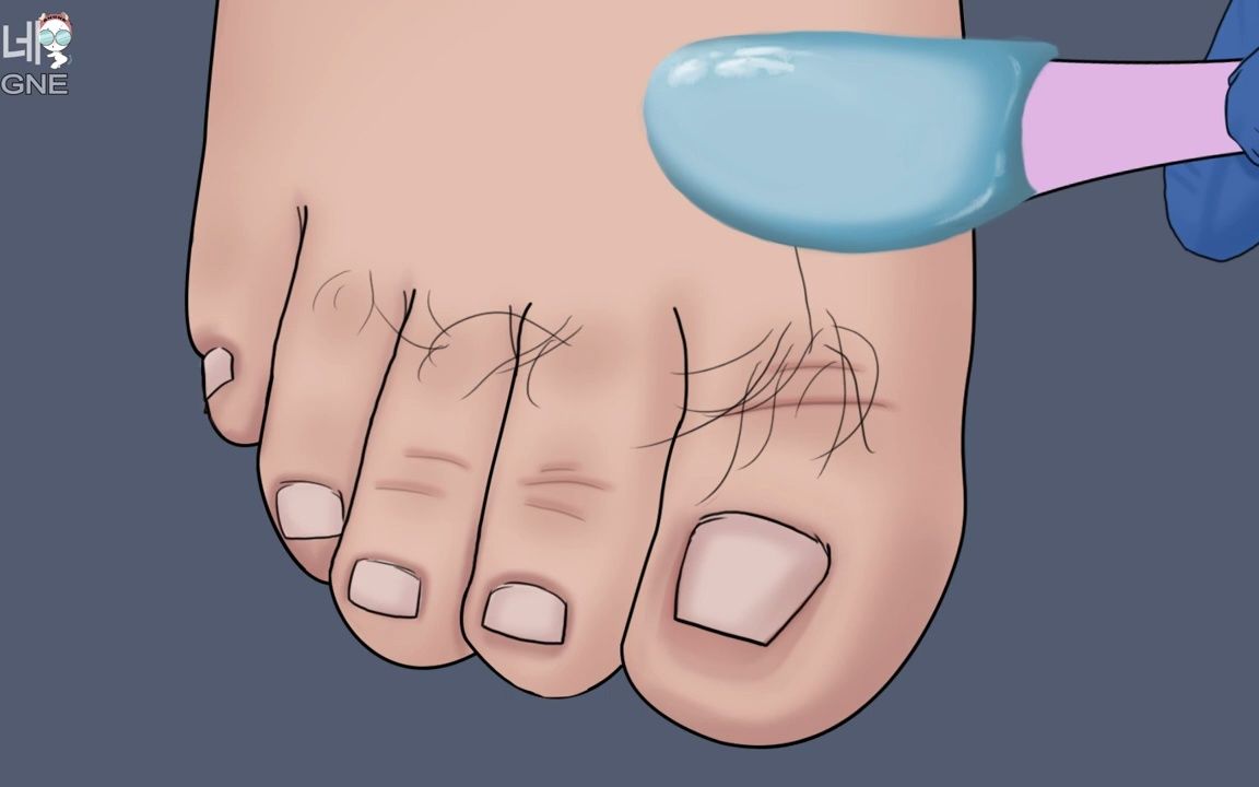 【沉浸式修脚】吃饭别看!内生脚趾甲去除治疗动画