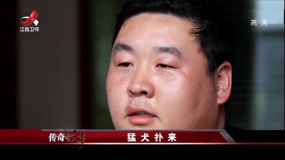 传奇故事:男子被狗撕咬,缝了一百多针,称自己看见狗都打哆嗦
