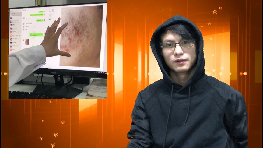痤疮恢复后会留下疤痕吗? 如何正确避免疤痕产生呢?