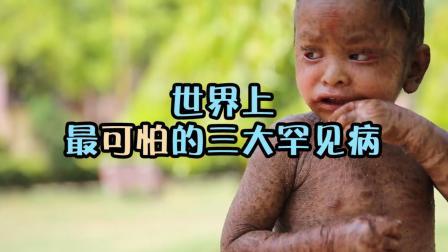 世界上最罕见的病症,全身被深黑色鱼鳞癣覆盖,而且目前无药可治