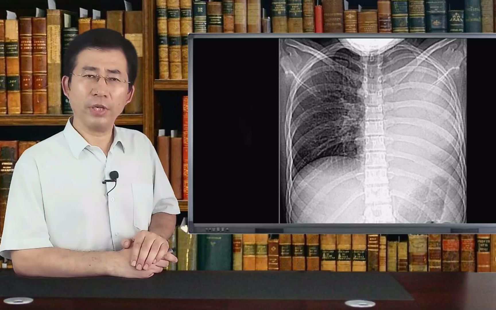 警惕库欣综合征有可能是肺类癌导致的肾上腺皮质激素长期分泌异常