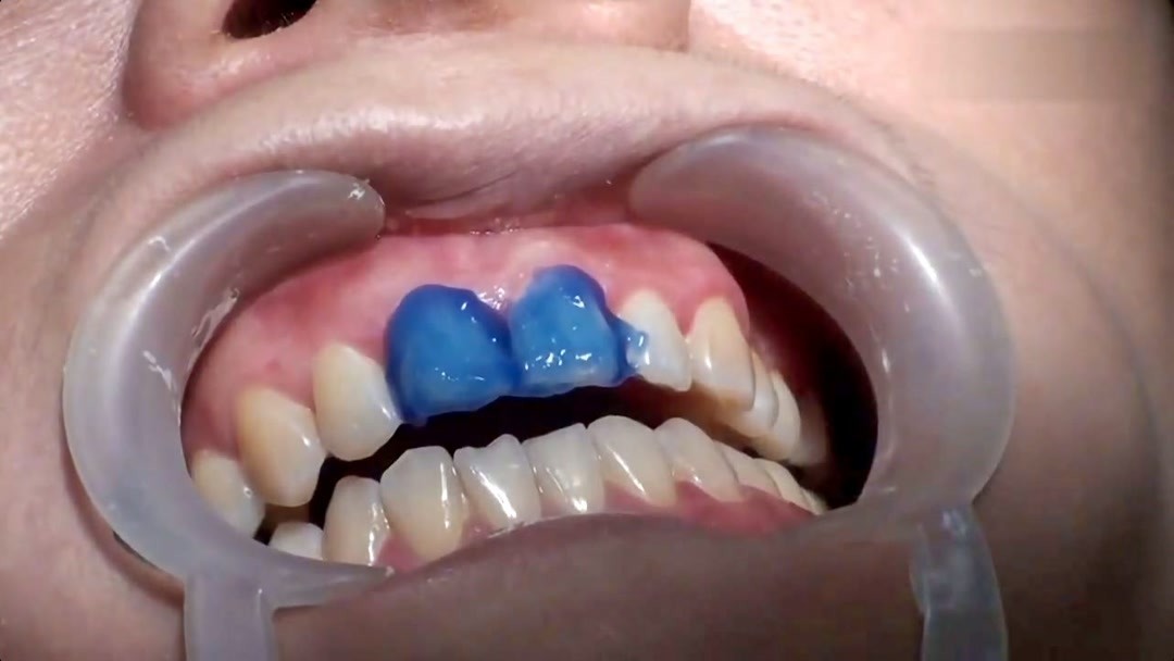 全瓷牙贴面修复牙齿的过程,真实拍摄整个变化!