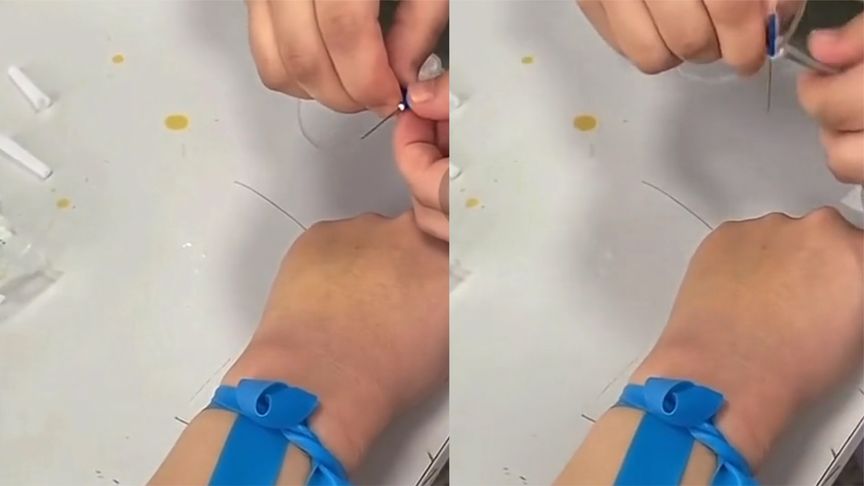 医学生握住针柄练习扎针,手臂不受控制疯狂颤抖:别毕业好嘛