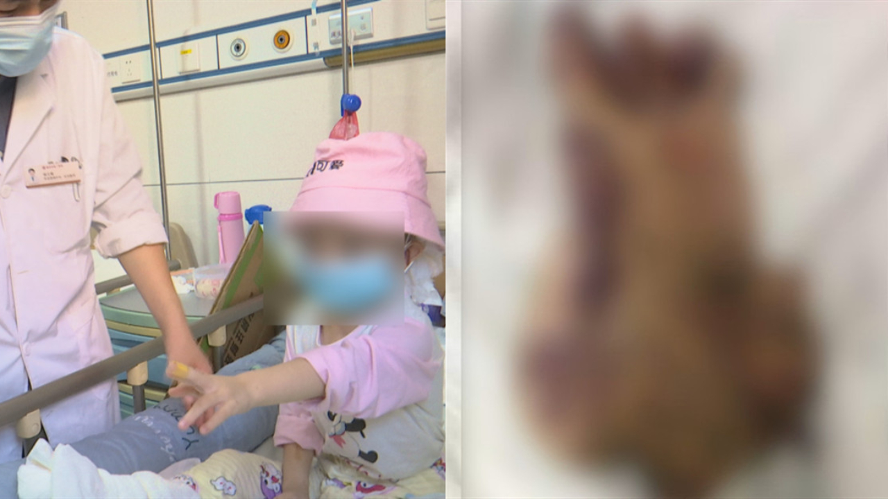 心疼!4岁女童不慎被渣土车碾压,右脚和小腿只剩下骨架