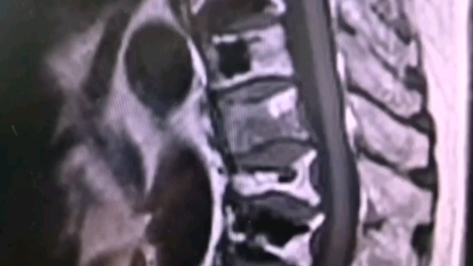 介入治疗基础教程:一丶单侧入路经经皮椎体成形术,治疗老年椎体压缩...