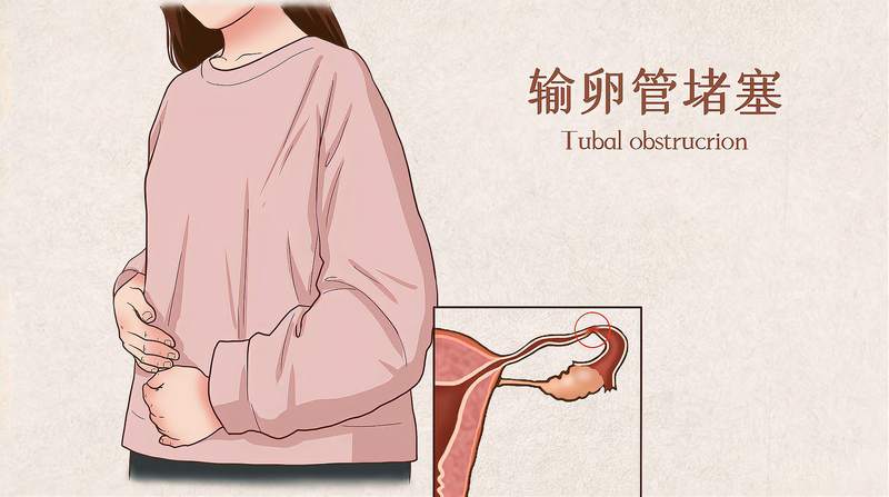 输卵管堵塞会导致不孕吗?来听专家怎么说!