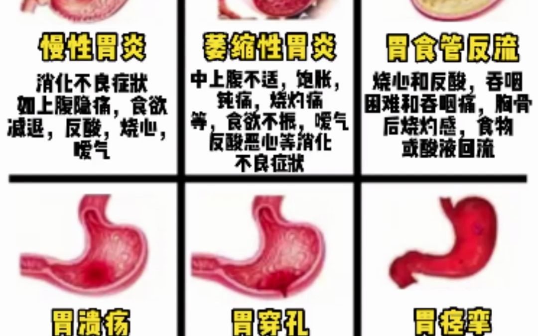 分辨6种胃病症状
